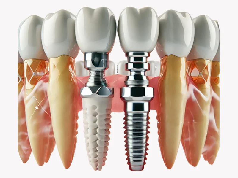 Multi-Unit Abutment For Dental Implants in Istanbul | Price, Process ...