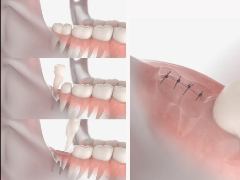 Surgical Tooth Extraction in Istanbul | Price, Process & Results | Dr ...